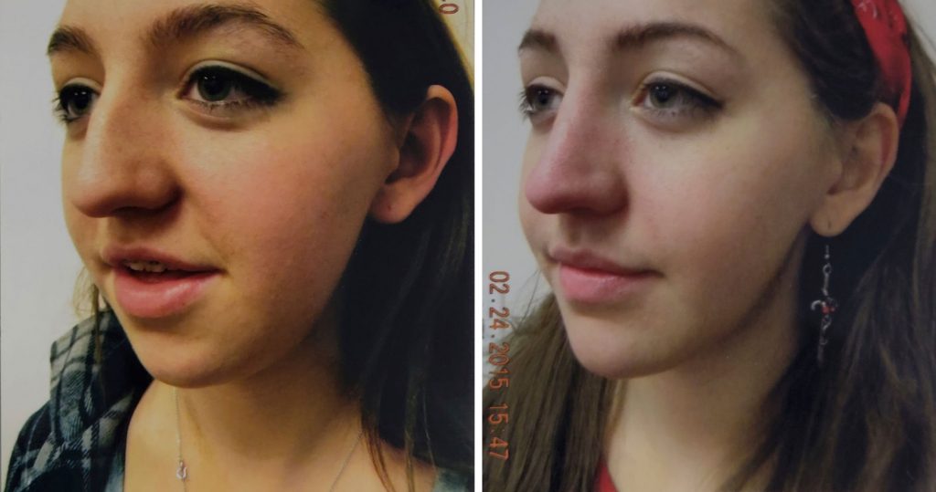 Corrective Jaw Surgery - Dr Hamilton