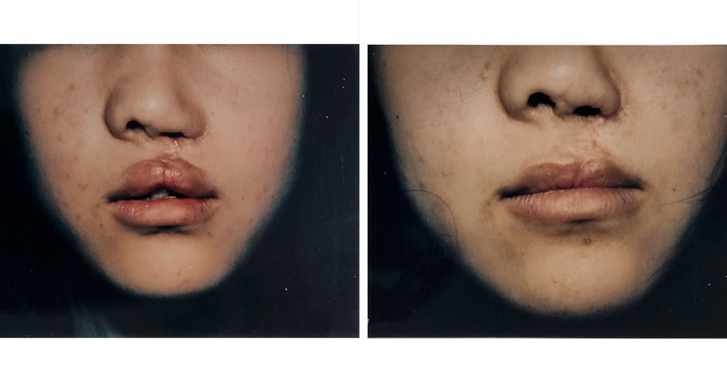 Cleft Lip and Palate Surgery - Dr Hamilton
