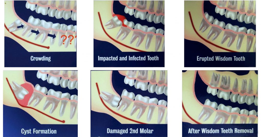 Wisdom Teeth - Dr Hamilton