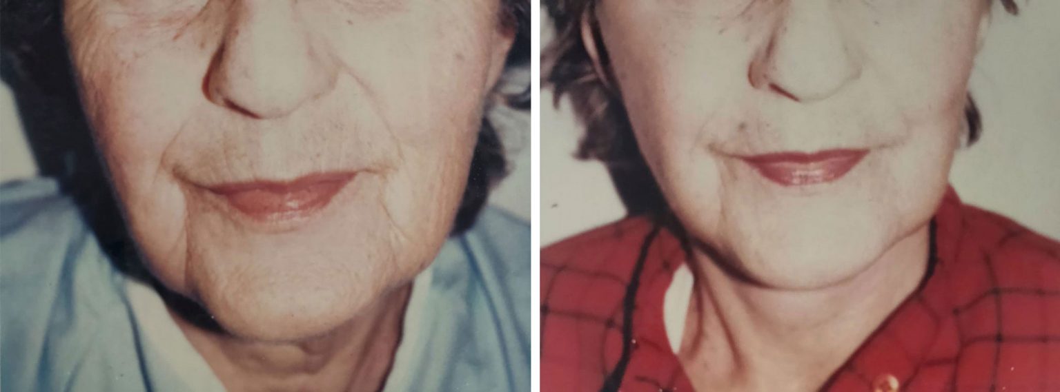 Autologous Fat Transfers - Dr Hamilton