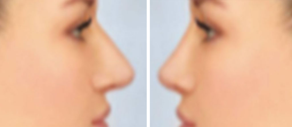 Facial Implants (Cheek, Chin, Nose, Jaw Angles) - Dr Hamilton