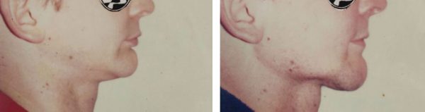 Facial Implants (Cheek, Chin, Nose, Jaw Angles) - Dr Hamilton