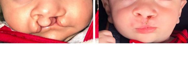 Cleft Lip and Palate Surgery - Dr Hamilton